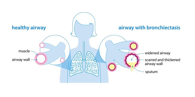 Bronchiectasis | Asthma + Lung UK